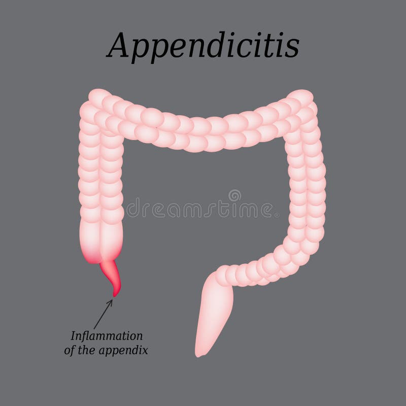 Caecum and appendix stock illustration. Illustration of appendicitis ...