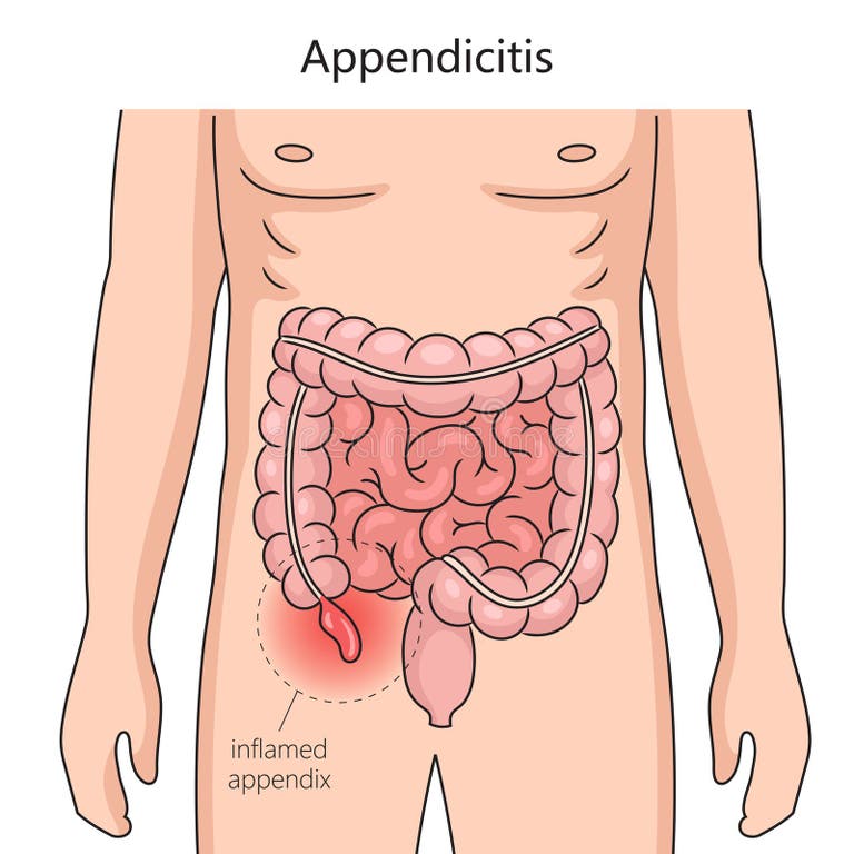 Appendicitis Inflammation of Appendix Medical Stock Vector - Illustration of organ, vomiting ...