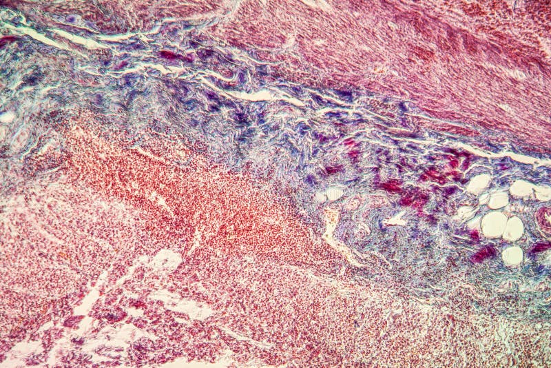 Appendicitis Inflammation Diseased Tissue Stock Photo - Image of ...