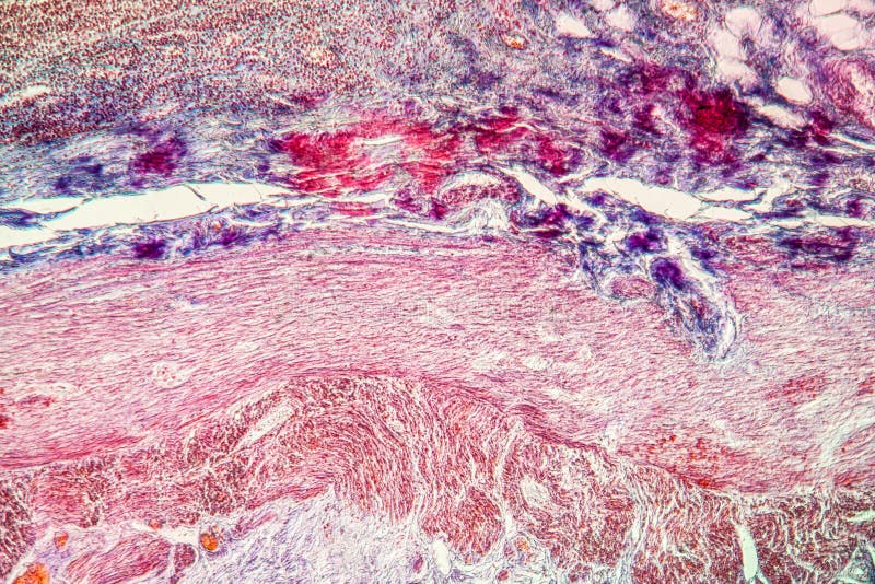 Appendicitis Inflammation Diseased Tissue Stock Image - Image of macro ...