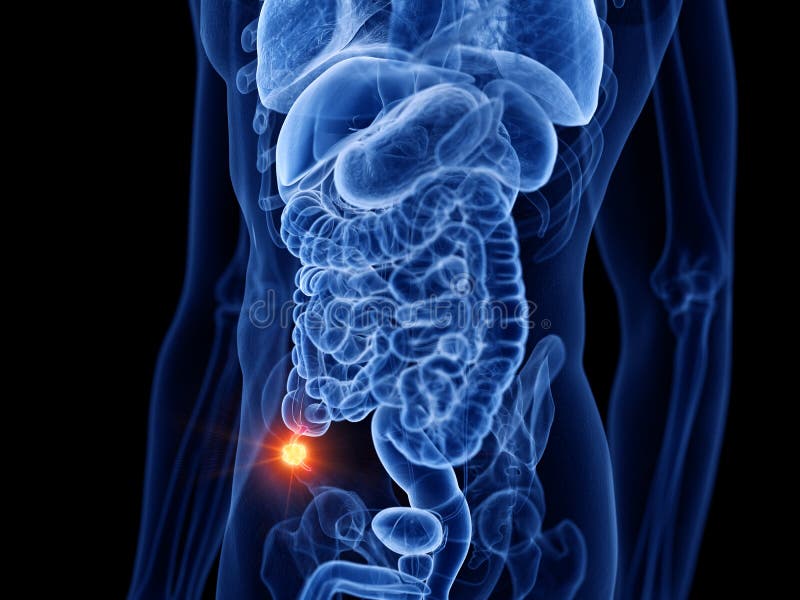 Appendix Cancer stock illustration. Illustration of tumor - 135118793