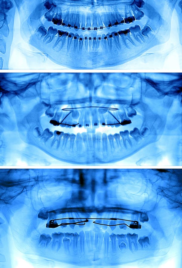 Fixed Appliance Brackets X-ray, Orthodontic Treatment Stock Image ...