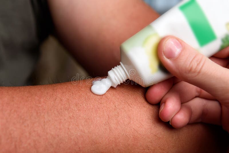 Applying Cream To the Skin of the Arm after Sunburn. Stock Image ...