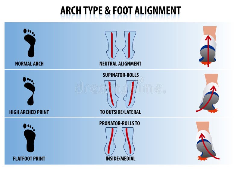Types Of Foot Arches