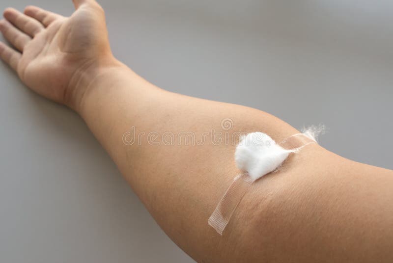 Arm bedeckte Gips stock abbildung. Illustration von medien - 47493376