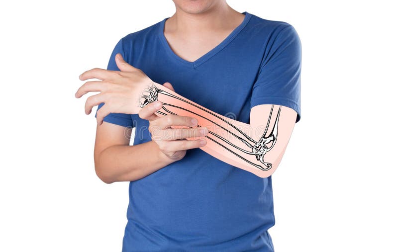 Arm bone injury stock image. Image of accident, bone - 317244565