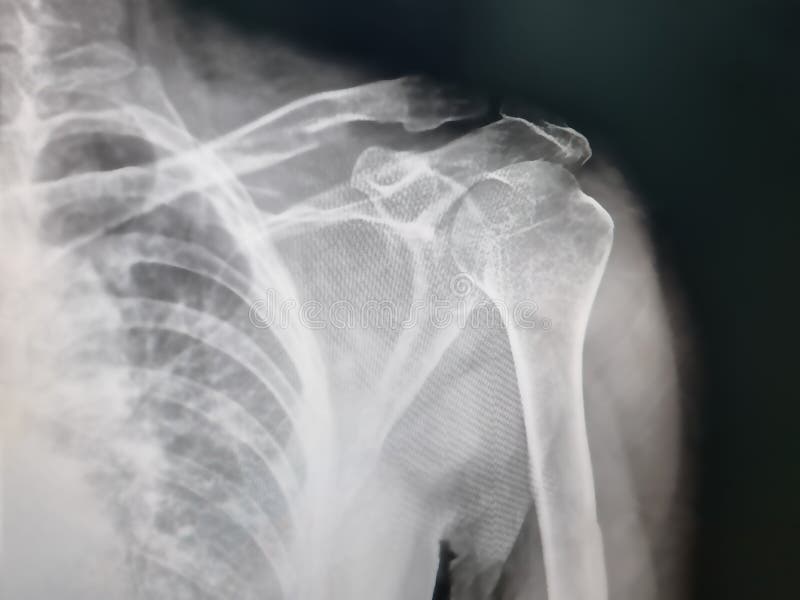 Arm Bone Xray Images Blur and Noise Stock Photo - Image of radiation ...