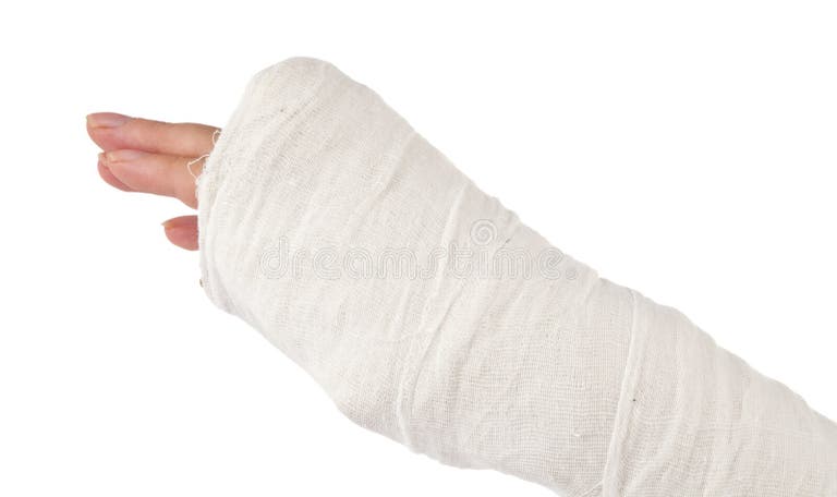 1,050 Arm Cast Splint Stock Photos - Free & Royalty-Free Stock Photos ...