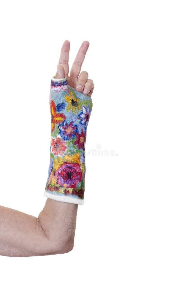 Arm in Decorated Cast Making Peace Sign Stock Photo - Image of gesture ...
