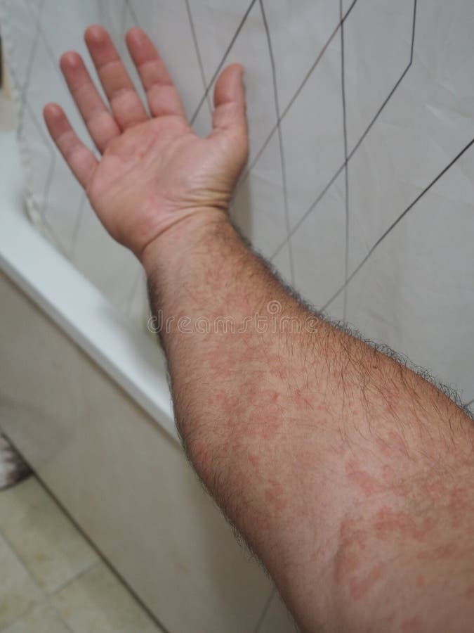 Arm Eczema Spots Caused Allergic Dermatitis Stock Photos - Free ...