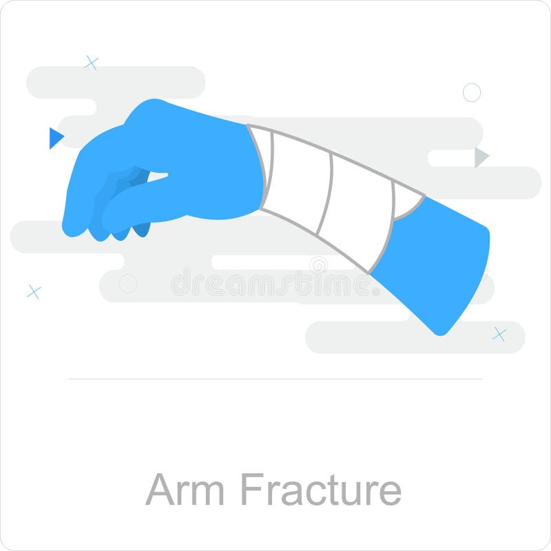 Arm Fracture stock vector. Illustration of fracture - 340613035