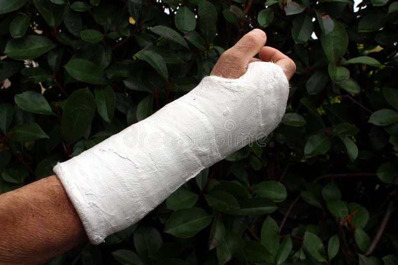 Arm im Gips stockbild. Bild von mann, daumen, finger - 34815255