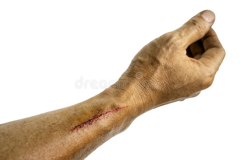 Arm Injuries from Work Accidents on a White Background Stock Photo ...