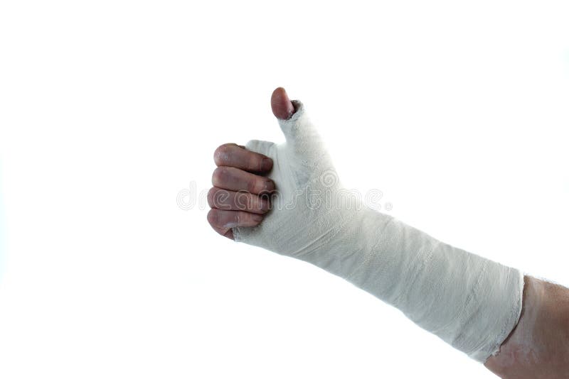 Arm in Plaster Cast stock image. Image of fracture, cast - 43468647