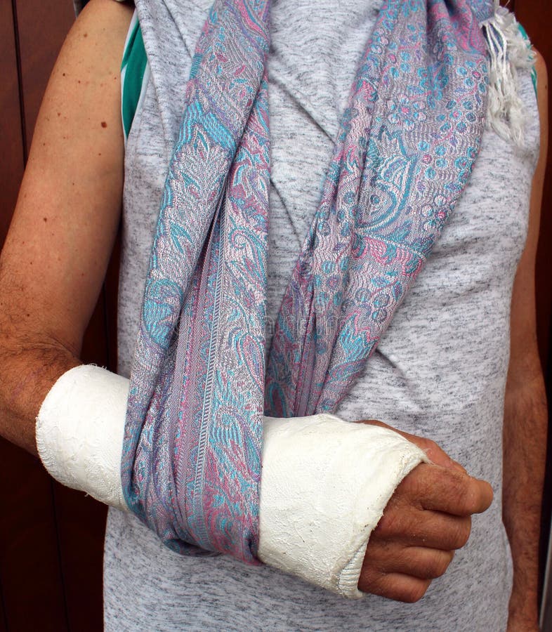 Arm in plaster stock image. Image of material, white - 34815255