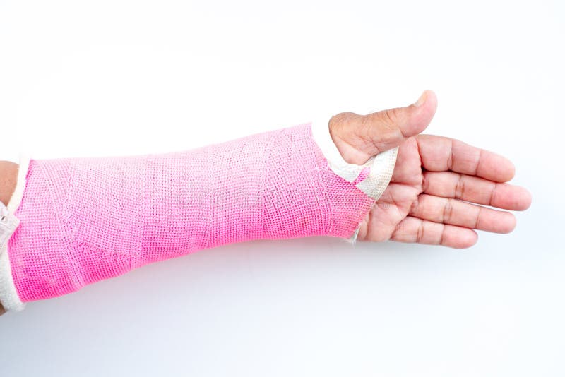 Arm splint stock photo. Image of protection, orthopedic - 75774538