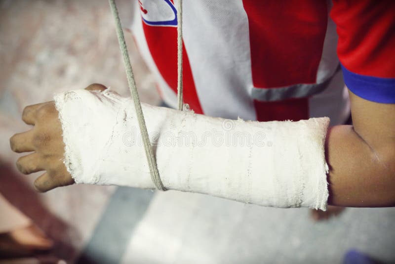 2,169 Arm Cast Plaster Photos - Free & Royalty-Free Stock Photos from ...