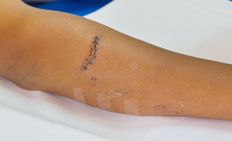 Stitch wound. stock photo. Image of hospital, health - 43444602