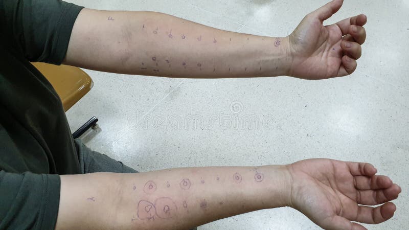 Arm Test of Allergy Droplet Examination Sensitive Symptom Red Rash All ...