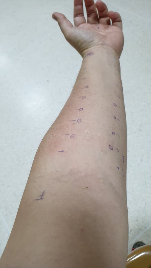 Arm Test of Allergy Droplet Examination Sensitive Symptom Red Rash All ...