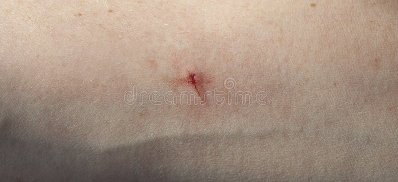 Hand with a Cut on the Hand Stock Photo - Image of injure, scar: 169475252