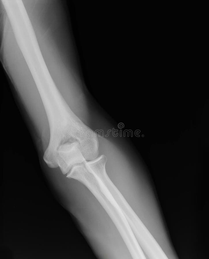 Arm xray stock photo. Image of body, medicine, film, surgical - 38277406