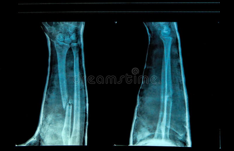 Armbruch Auf Röntgenbild Sichtbar Stockfoto - Bild von medizin ...