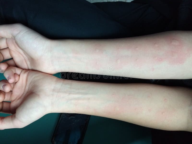 Arms of a Kid Swolen after Allergy Tests Stock Image - Image of parts ...