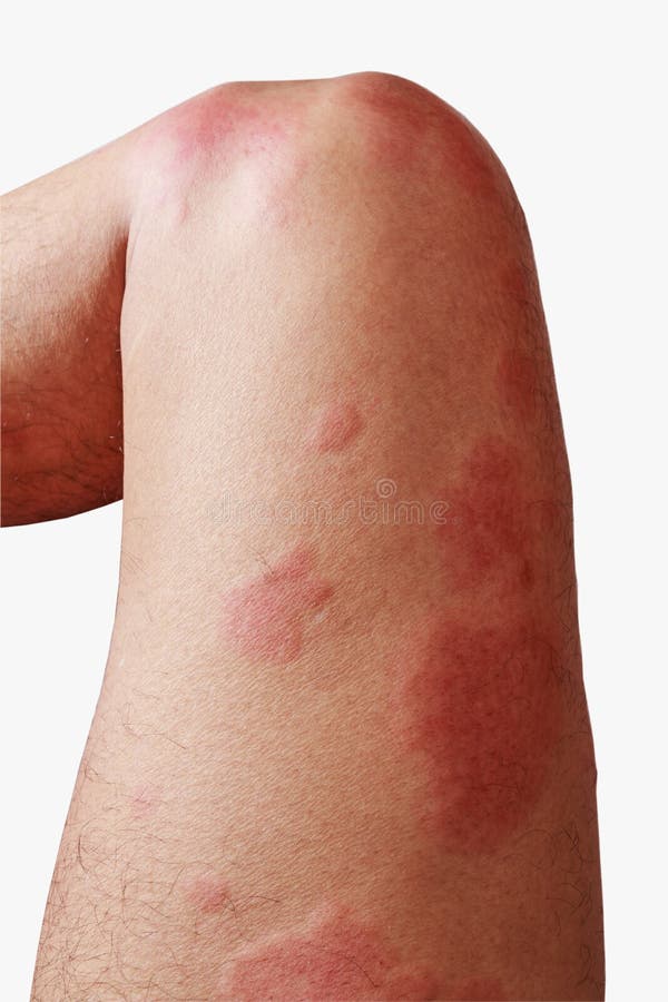 Around Legs Allergy Rash and Health Problem. Stock Photo - Image of ...