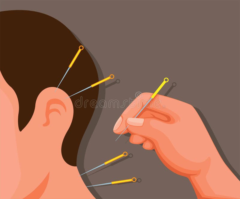 Chinese Traditional Acupuncture Cartoon Illustration Vector Stock ...