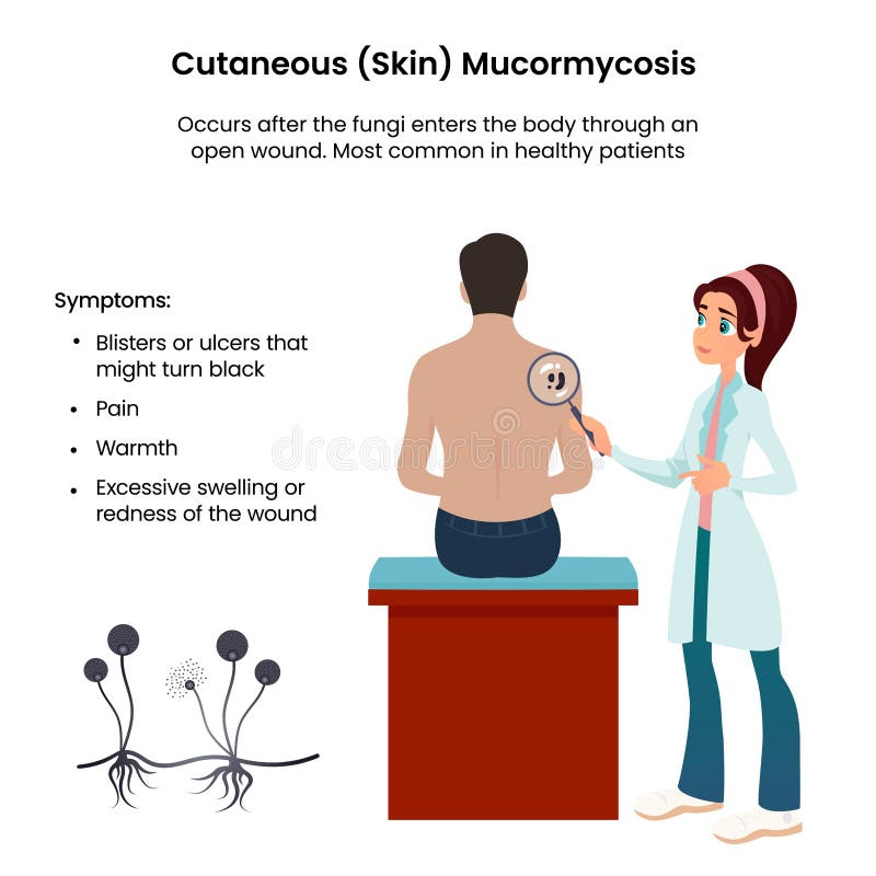 Cutaneous Mucormycosis Vector Illustration Informational Graphic Stock ...