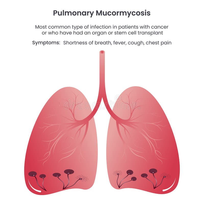 Pulmonary Mucormycosis Vector Illustration Informational Graphic Stock ...