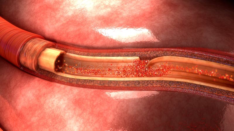 Arterien-Zerlegung stockbild. Bild von infarktbildung - 84219485