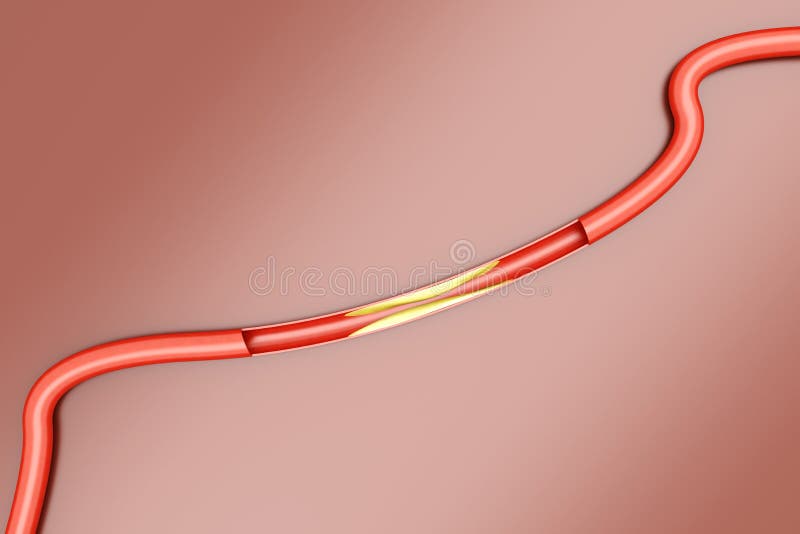 Arteriosclerose ilustração stock. Ilustração de cardiologia - 28643653