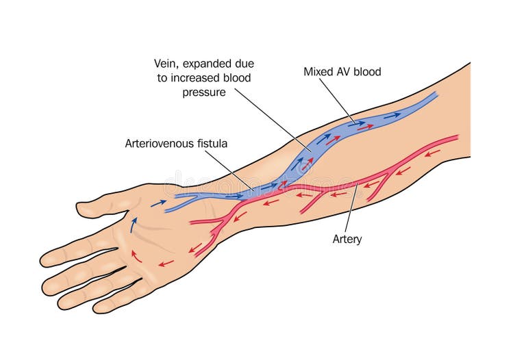 Arteriovenous Fistula Stock Illustrations – 15 Arteriovenous Fistula ...