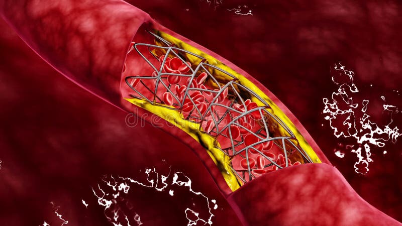 Artery Cross-section with Blood Flow, Fat Plaque and Stent Deployment ...