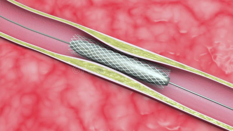 Artery Cross-section Showing Stent Deployment Stock Footage - Video of ...