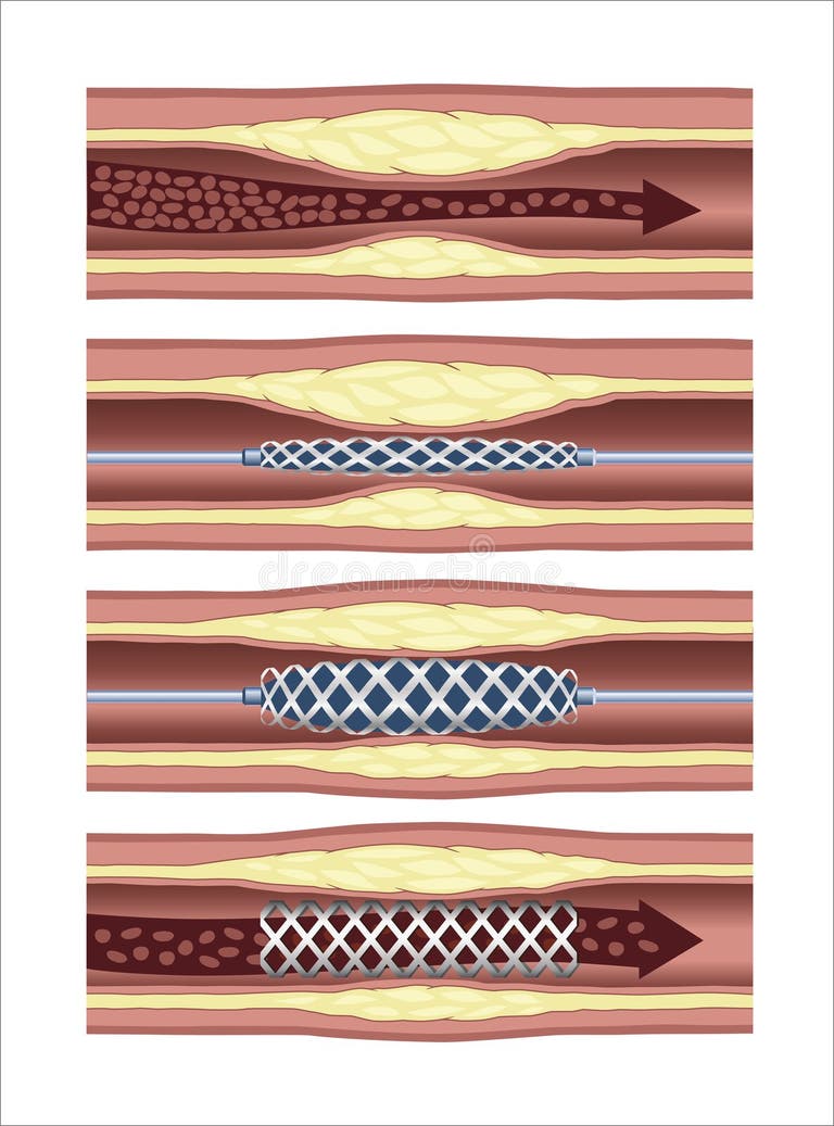 Coronary Stent Stock Illustrations – 594 Coronary Stent Stock ...