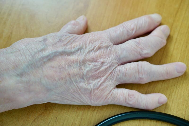 Arthritic Womens Hand with Bone Deformity Stock Photo - Image of ...