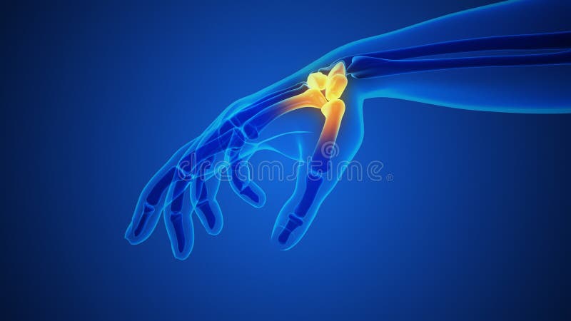 Arthritis of the Finger and Thumb Joint Stock Illustration ...