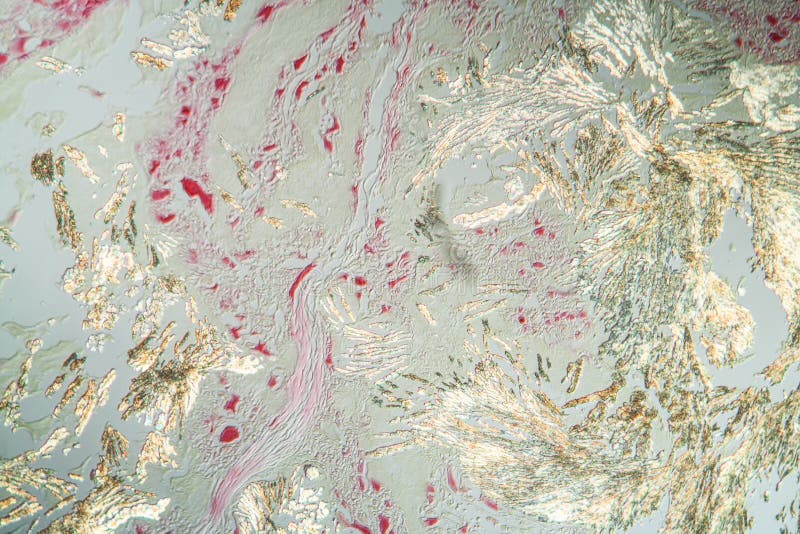 Arthritis Gout Crystals in the Cells Tissue Section Stock Image - Image ...