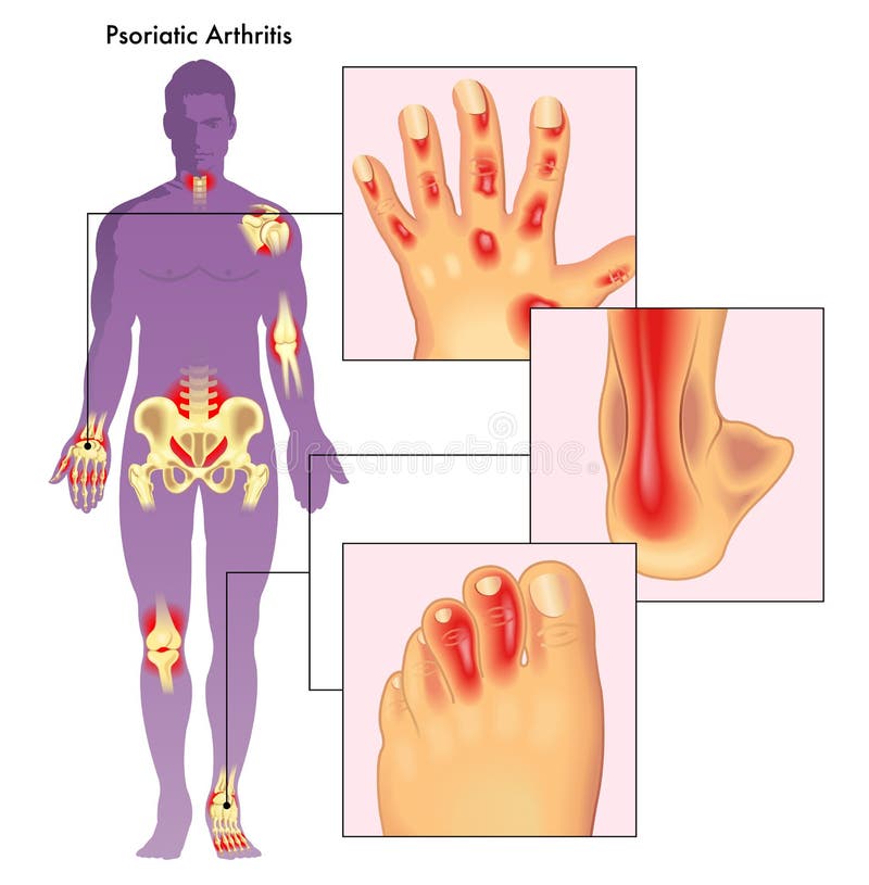 Arthritis psoriatica vektor abbildung. Illustration von schmerz - 44183308