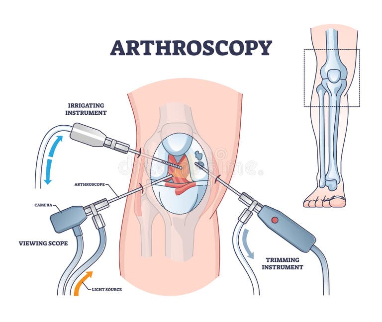 Arthroscopy Stock Illustrations 278 Arthroscopy Stock Illustrations