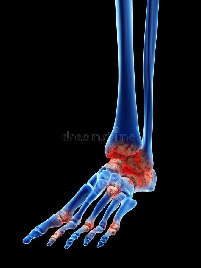 Arthrosis in the foot stock illustration. Illustration of closeup ...