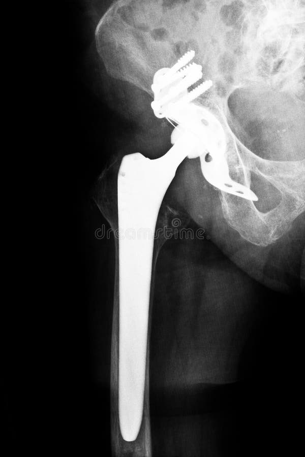 Artificial hip joint stock photo. Image of human, imaging - 26061034