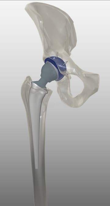 Artificial Hip Stock Illustrations – 774 Artificial Hip Stock ...