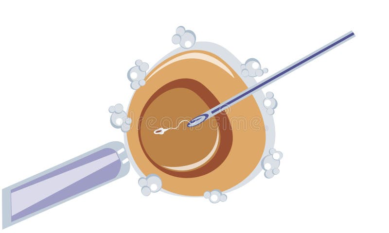 Artificial Insemination of Oocyte, Intracytoplasmic Injection, IVF ...