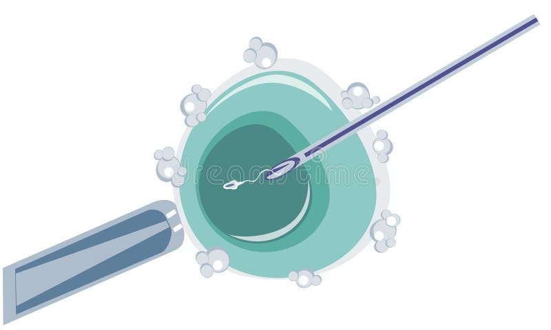 Artificial Insemination of Oocyte, Intracytoplasmic Injection, IVF-2 ...