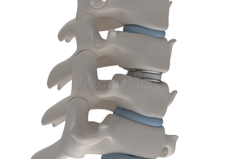 Artificial Intervertebral Disc Prosthesis is Installed between T Stock ...