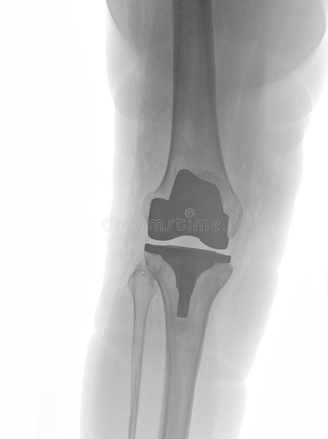 Prosthetic Leg and Knee Mechanism Stock Image - Image of revival ...